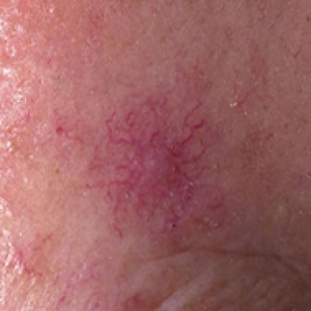 Spider Angioma Classification Dataset by Liverify