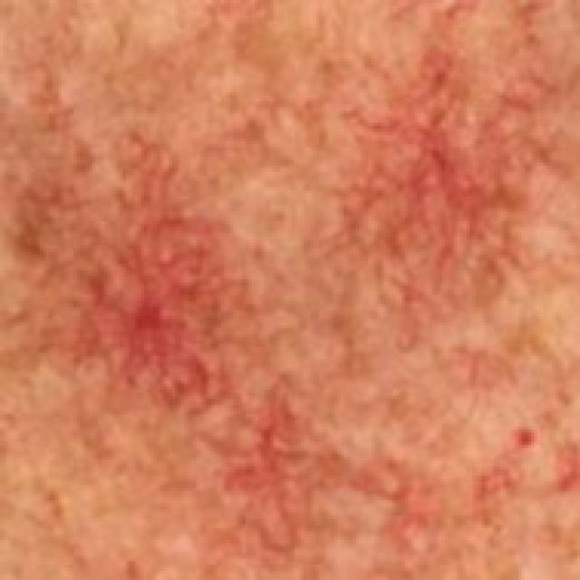 Spider Angioma Stage 34 Liver Cirrhosis Fatty Liver Chronic Liver Disease Object