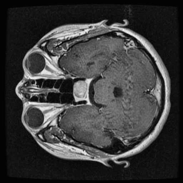 Tumor Object Detection Dataset by talha