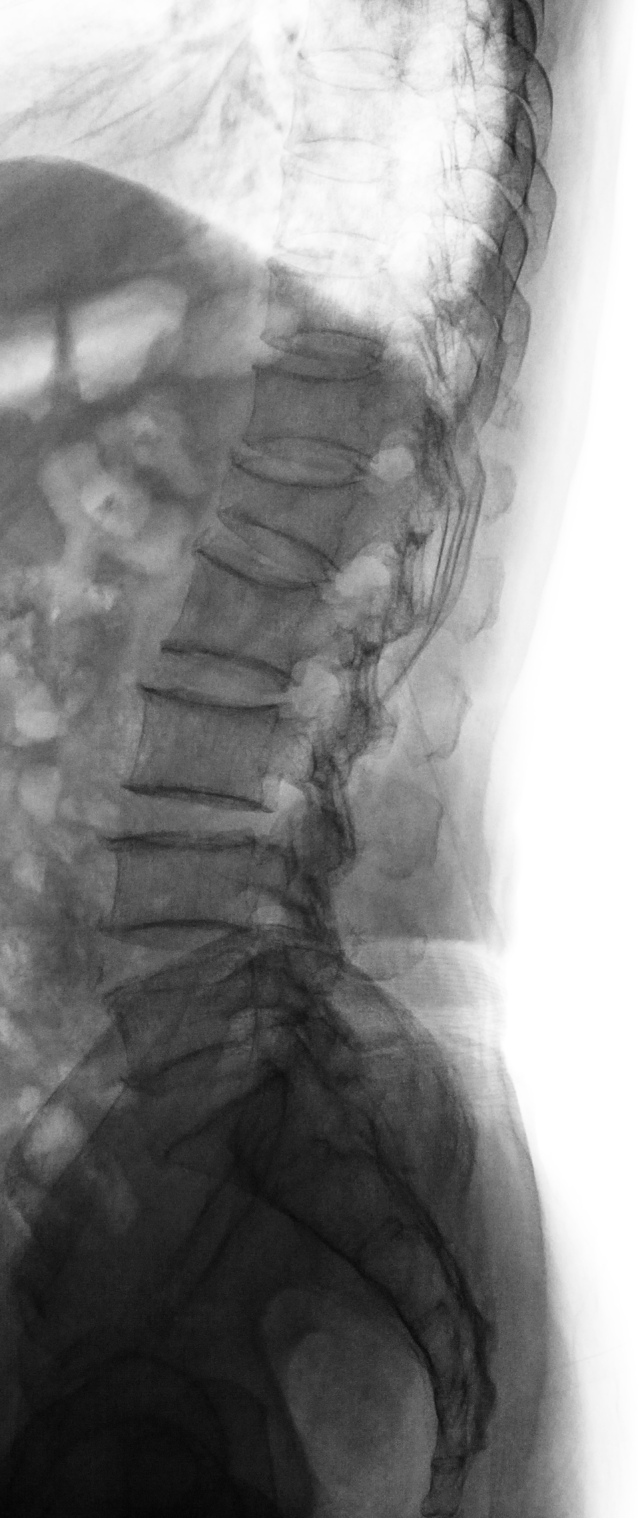 spinefrxhard Object Detection Model by spine fracture hardware validation