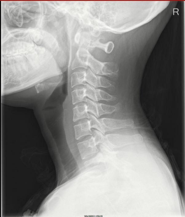 neck_xray Object Detection Model by Baddewithana P