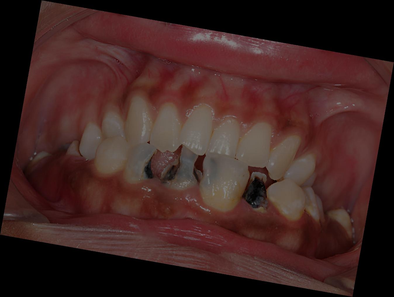 teeth-disease 2 Object Detection Model by Oral Disease Detection