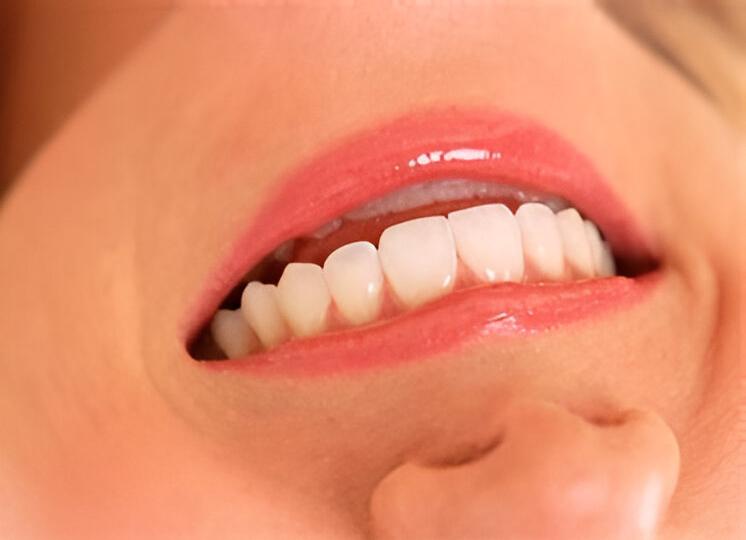 teeth-disease Object Detection Model by Oral Disease Detection