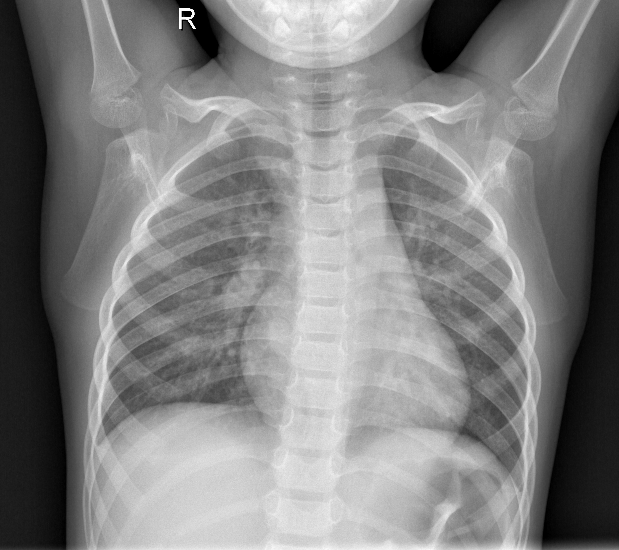 Chest X-ray Pneumonia Classification Model by ADC