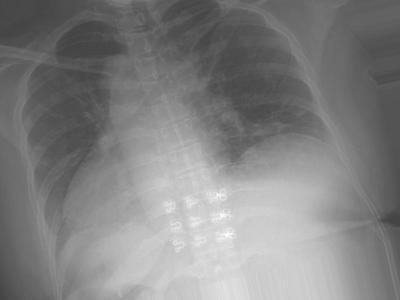 Lung Disease Detection Object Detection Model by AI