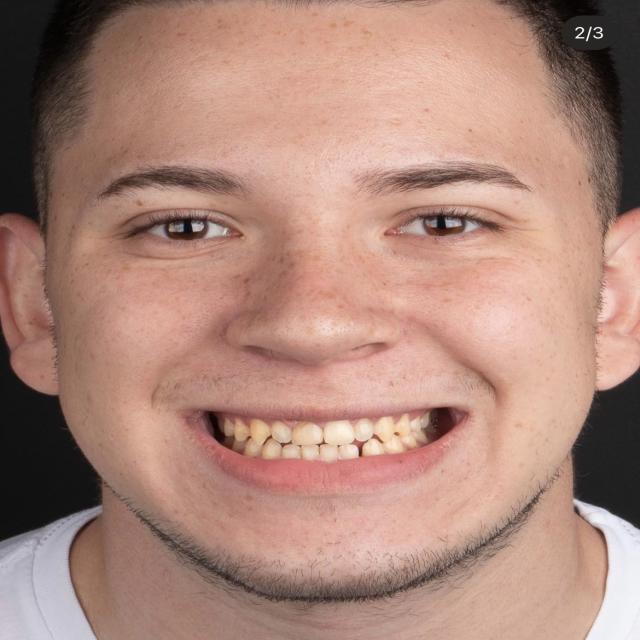 Smile top teeth Instance Segmentation Dataset by Avila