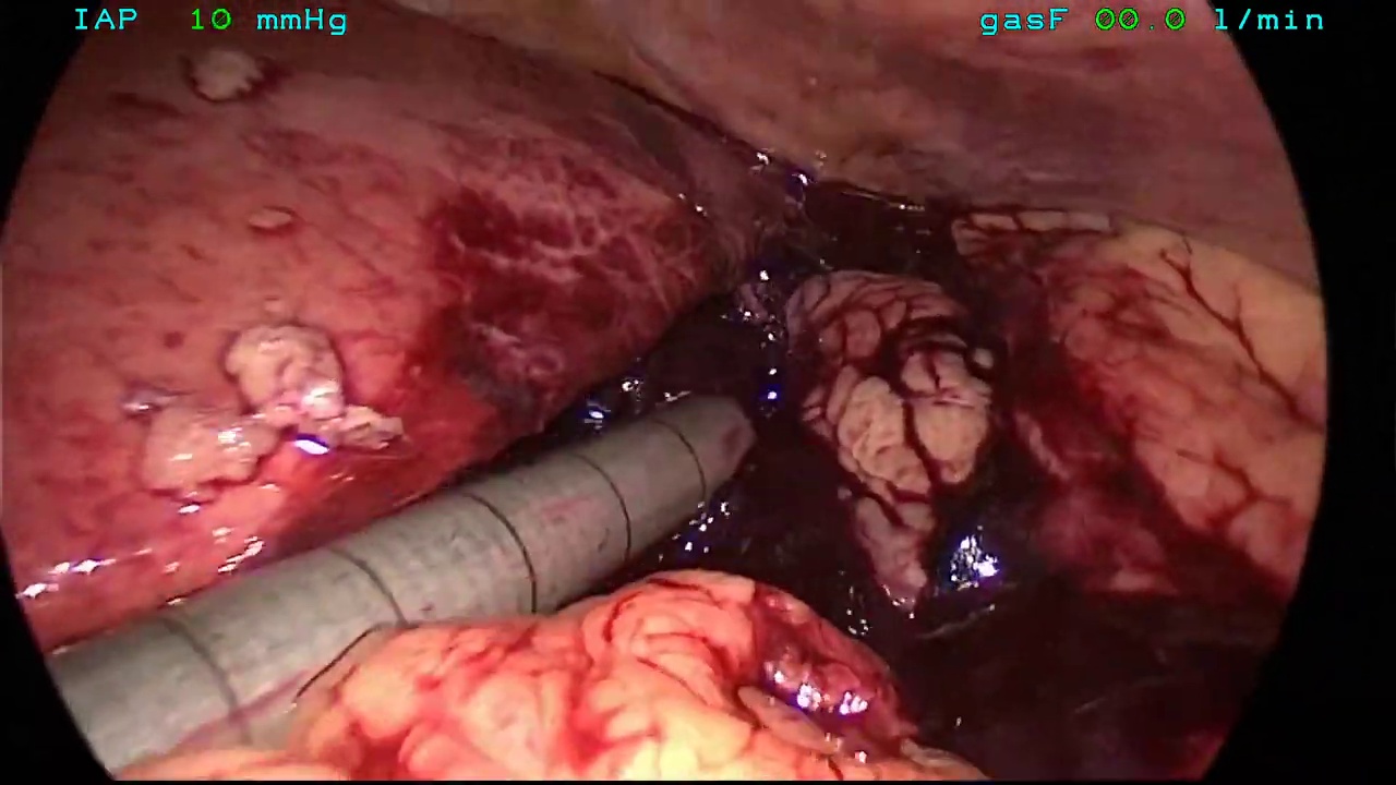 Bleeding Detection Object Detection Dataset By Sai Workspace