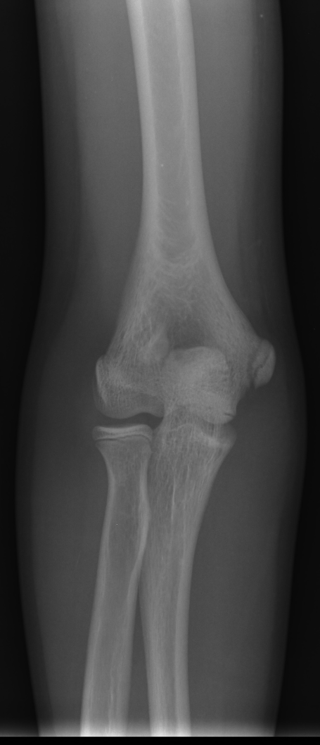 bone cancer detection Classification Dataset and Pre-Trained Model by bone