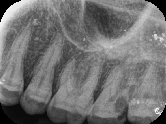 6 Dental Caries Proximal Object Detection Dataset By Nawinee