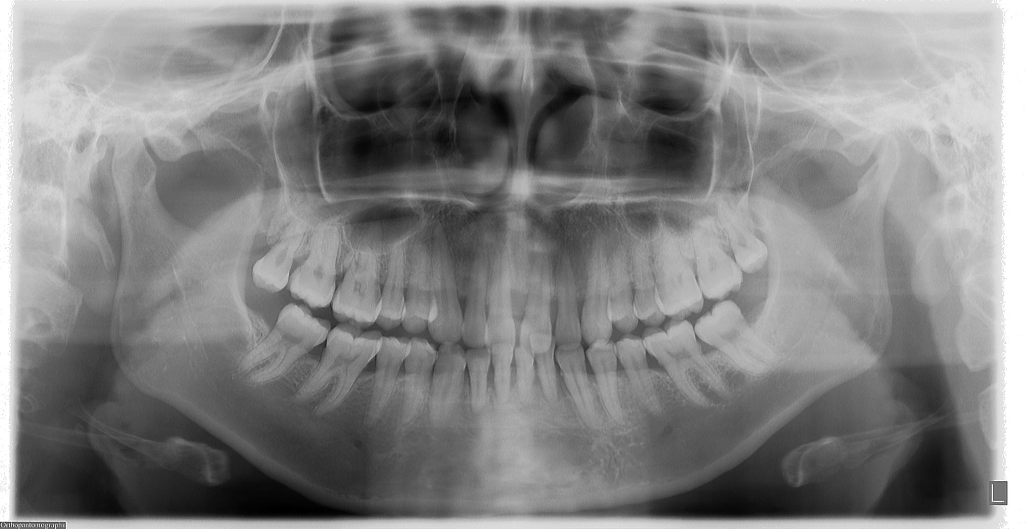 2d tooth segmentation pano (2d-tooth-segmentation-pano-tzzvf ...