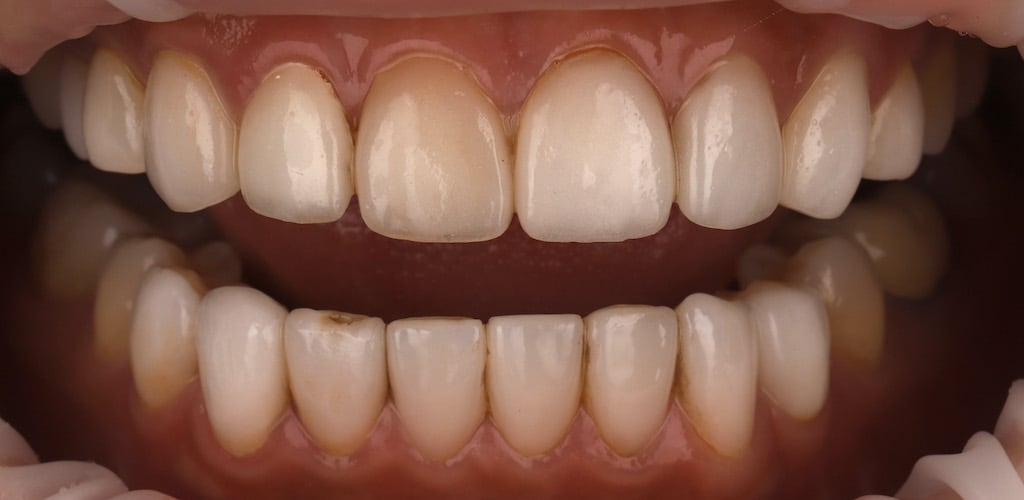 teeth Object Detection Model by spy