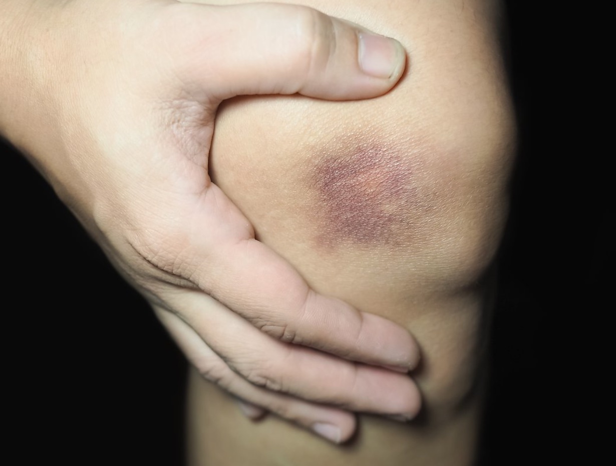 bruise detector Object Detection Model by Pukyong National University