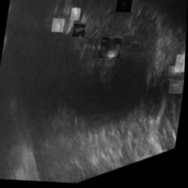 kidney stone detection ***** Object Detection Dataset and Pre-Trained Model by selina