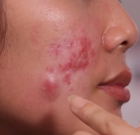 Acne Data Object Detection Dataset by face detection