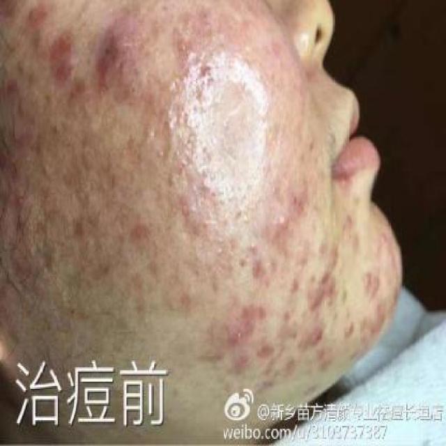 Acne Types Detection Object Detection Dataset And Pre Trained Model By Sujal Gupta