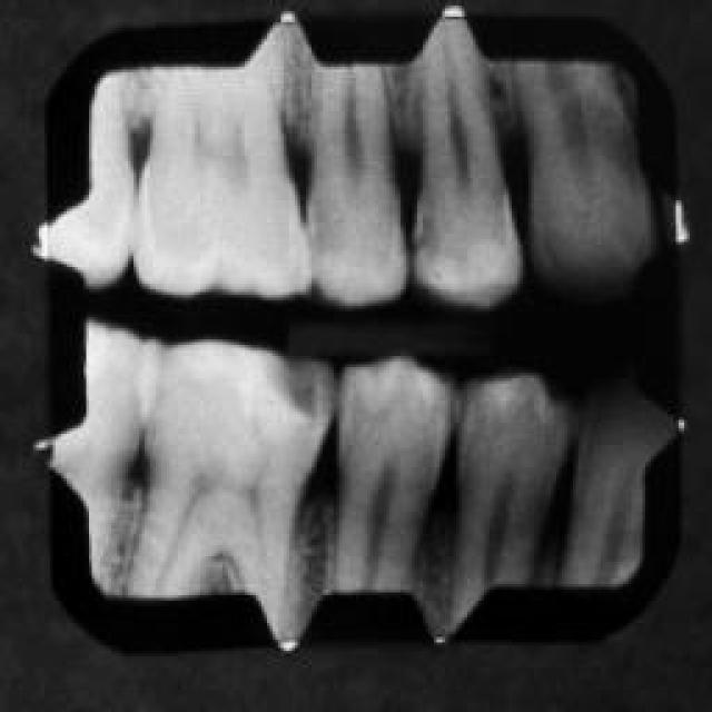 How To Use The Caries Detection Instance Segmentation Api 9234