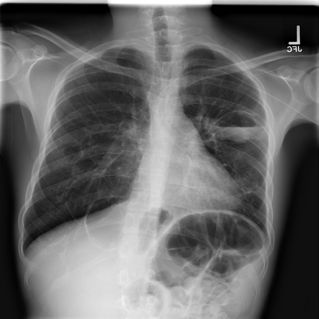 Detecting COPD Using x-ray Object Detection Model by jorence giron