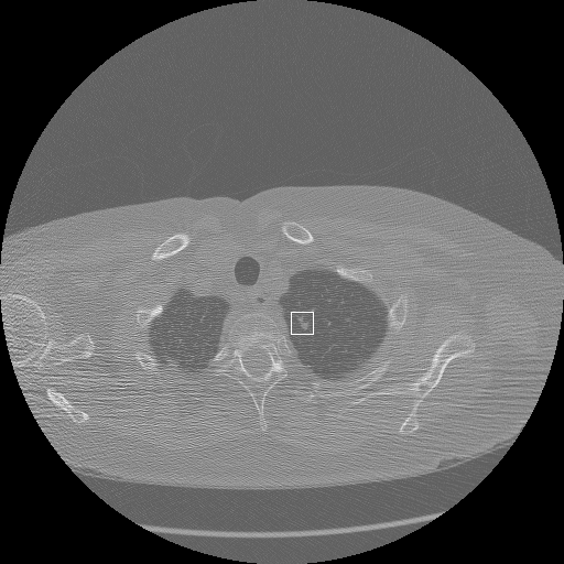 Nodule Detection Object Detection Dataset By Ntu