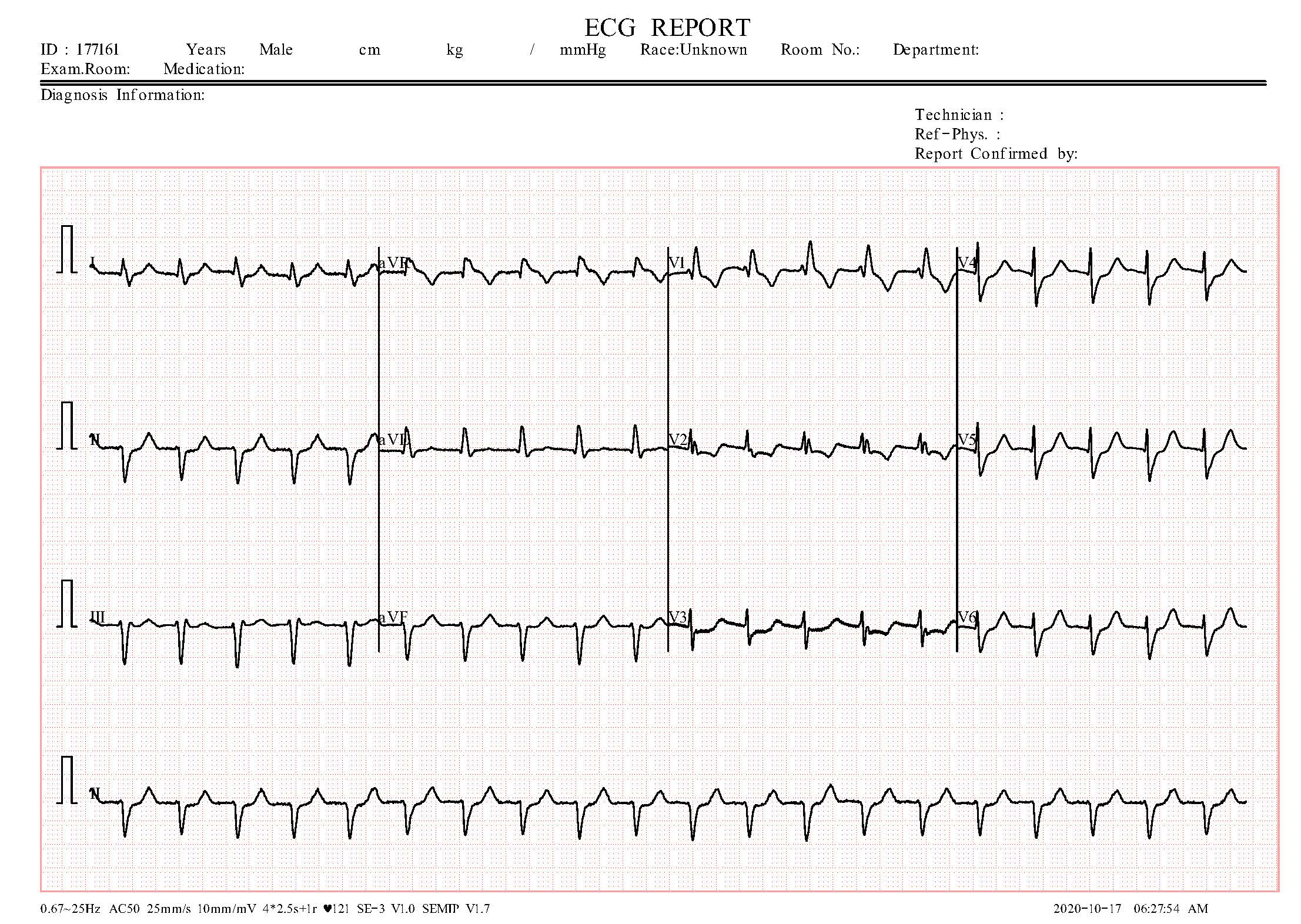 mit-bih Classification Dataset by WASSIM