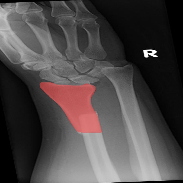 Keypoint Ulna Object Detection Dataset By Kmutnb