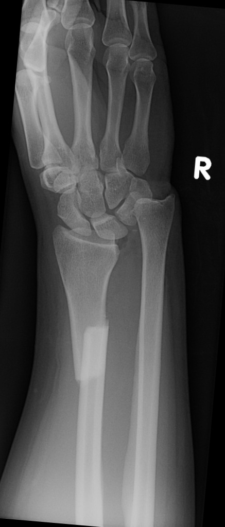 Segmentation Ulna Object Detection Dataset By Kmutnb