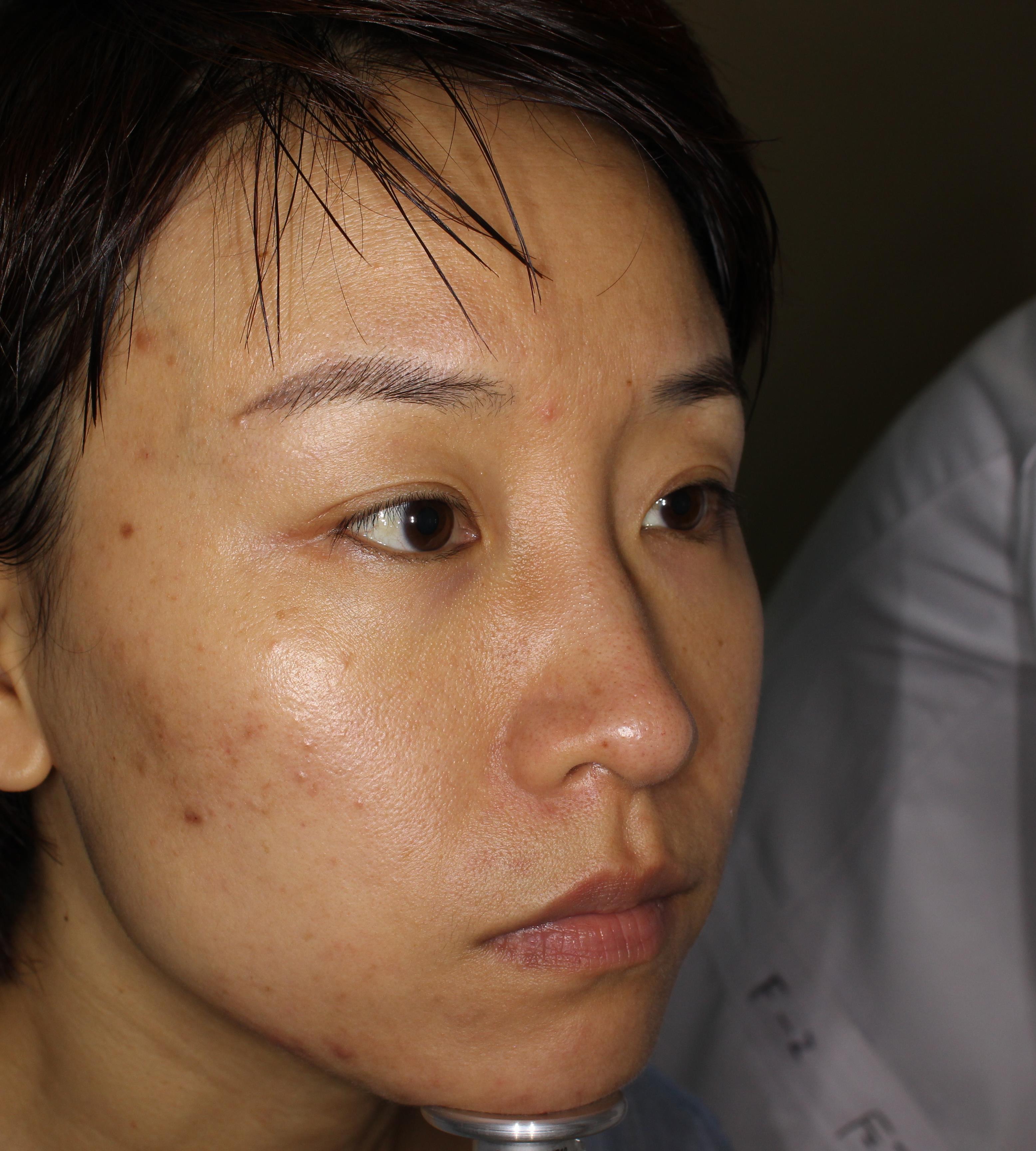 Acne Detection Yolo Object Detection Dataset By Zetten