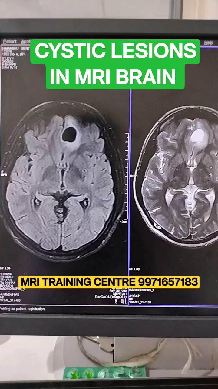 Brain Tumor Detection Object Detection Dataset And Pre Trained Model By Kiruba K