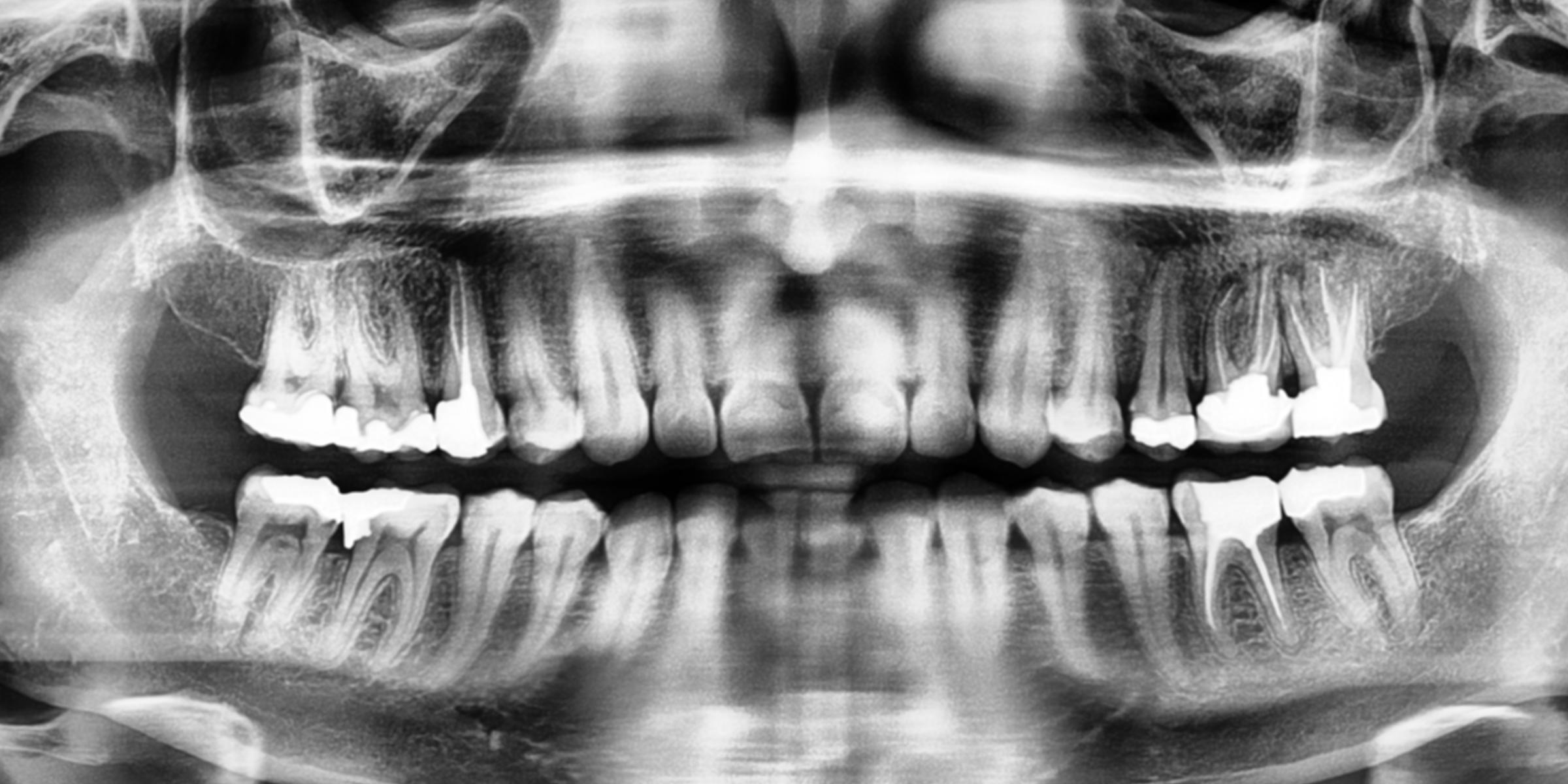 P Prueba 1 Object Detection Dataset And Pre Trained Model By Cavities