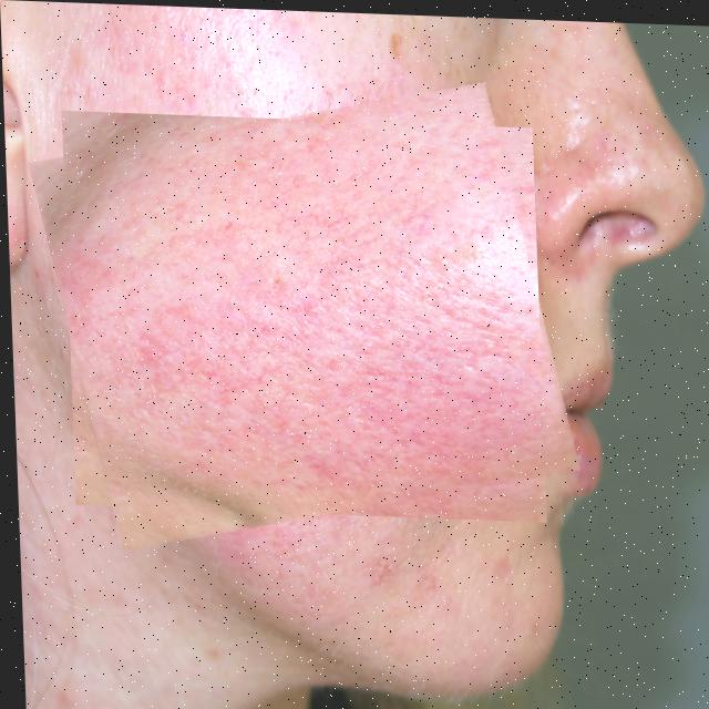 redness Instance Segmentation Dataset by A Projects