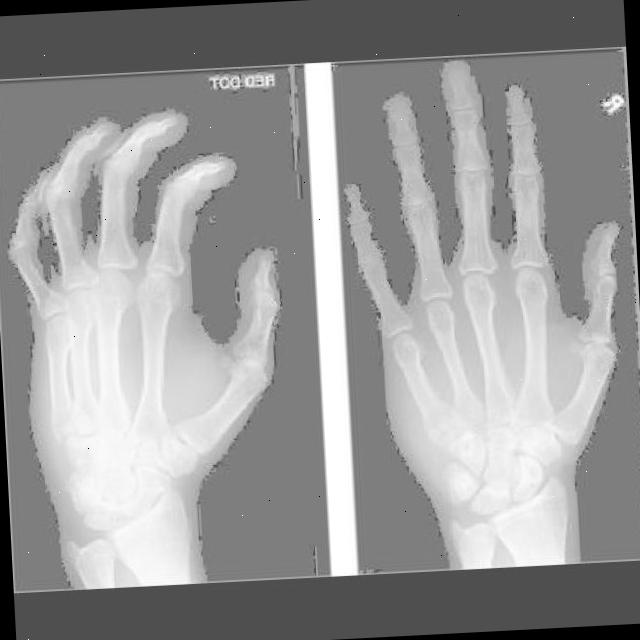 How To Use The Fracture Detection Object Detection Api 9262