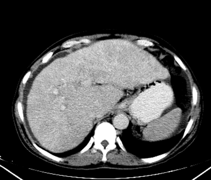 CT lesion Object Detection Dataset by liver