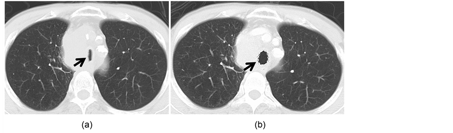 Tracheal Cancer Object Detection Dataset and Pre-Trained Model by ...