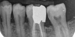 ICCMS Dental Caries Instance Segmentation Model by MSECEAIA