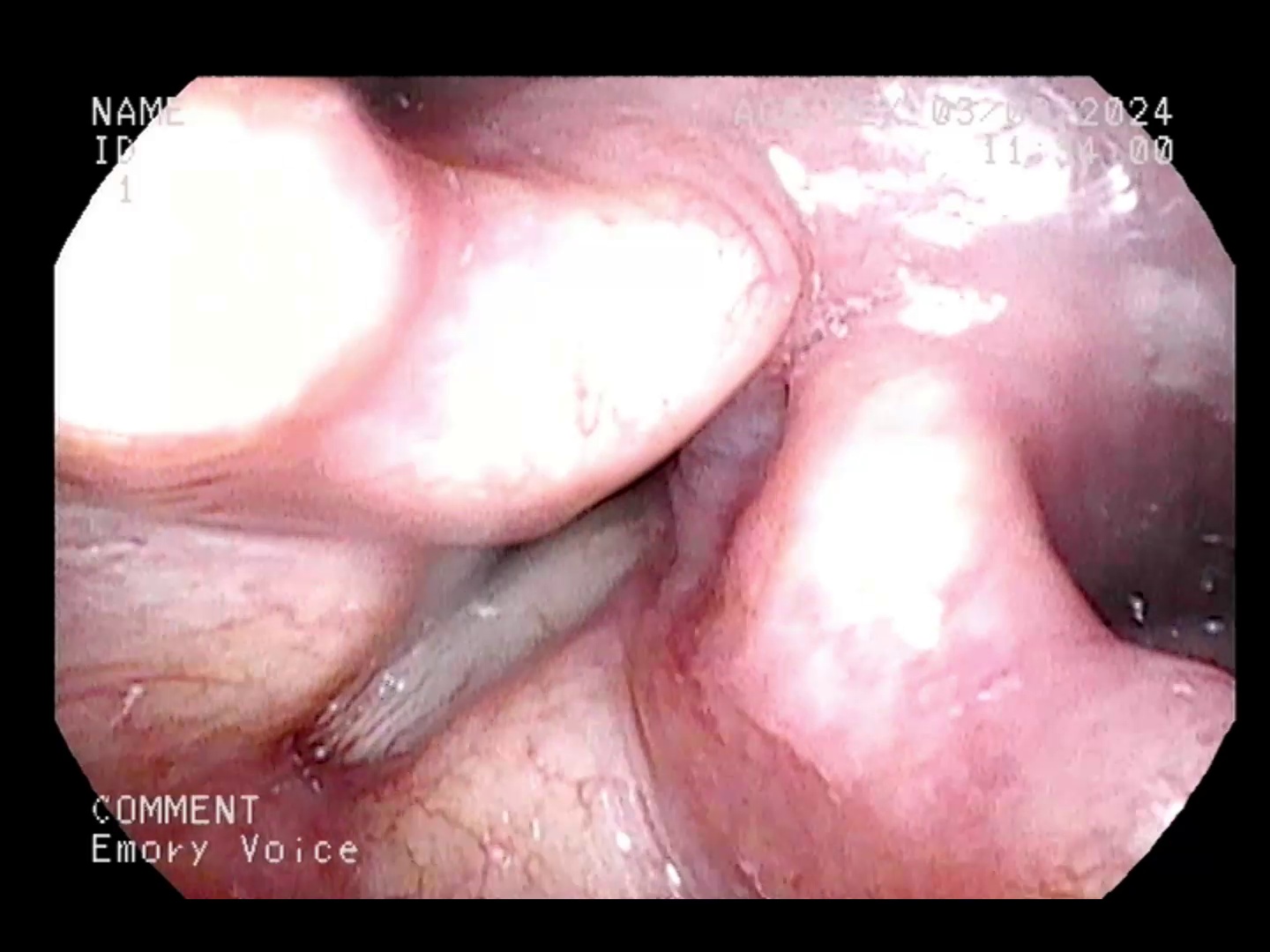Emory 2025 VF Dataset Instance Segmentation Dataset and Pre-Trained Model by Emory