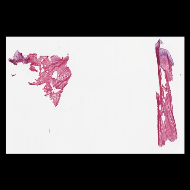 Ovarian Cancer - 2 - DATA6000 Classification Dataset and Pre-Trained Model by DATA6000 CAPSTONE