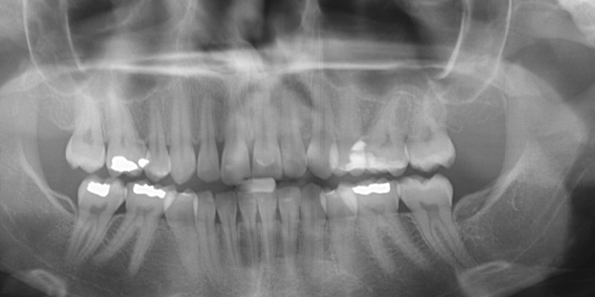 Teeth Disease Object Detection Dataset by North South University