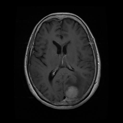 Brain Tumor Detection Object Detection Dataset And Pre Trained Model By