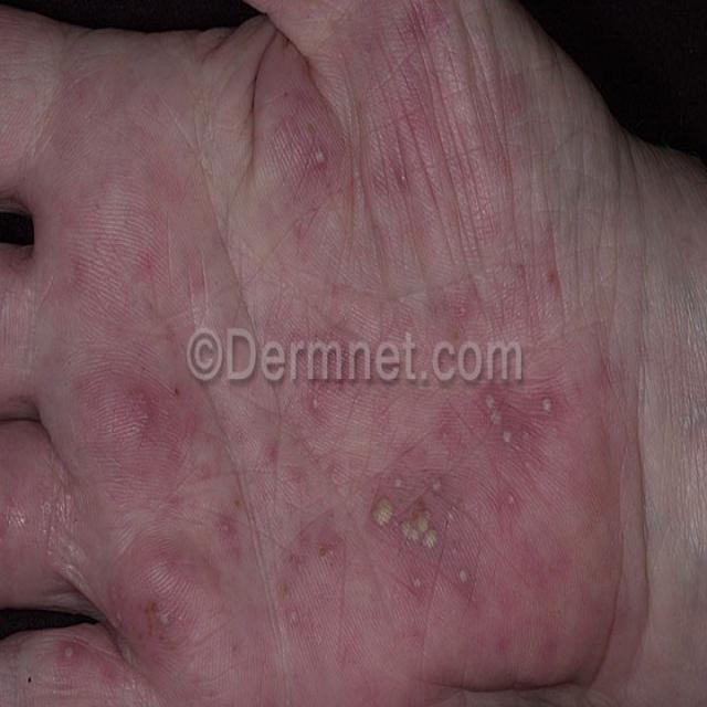 Derma Net Object Detection Model by Derma Advisor