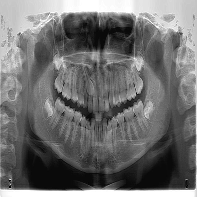 teeth-seg-3537 Instance Segmentation Model by Godento2