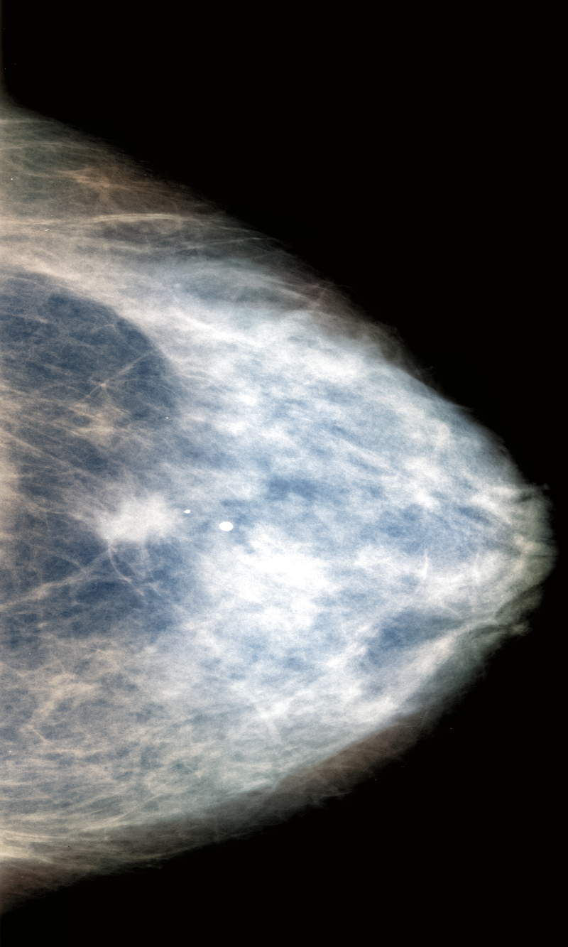 Ddsm Object Detection Dataset By Massdetectclass