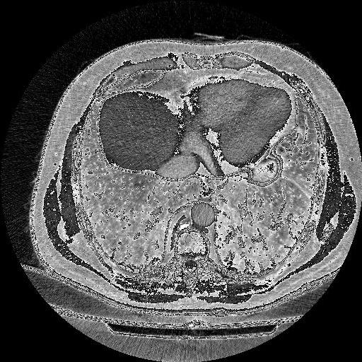 5A_Liver Tumor Instance Segmentation Dataset and Pre-Trained Model by Classification brain tumor