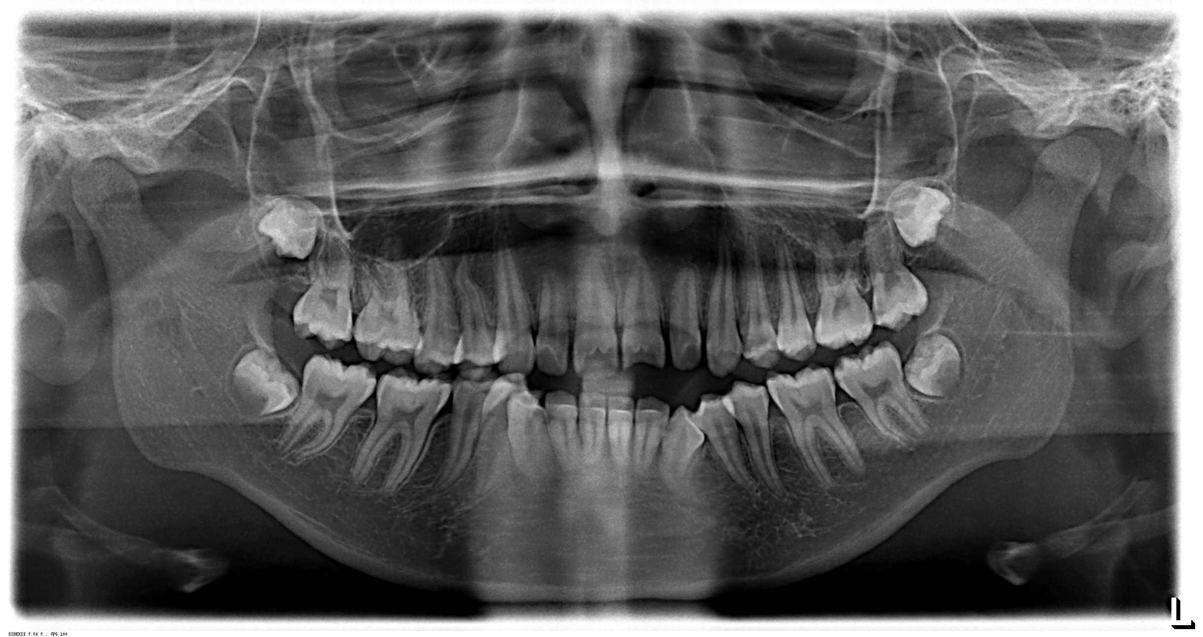 OPG (opg-bttr0) - Roboflow Universe