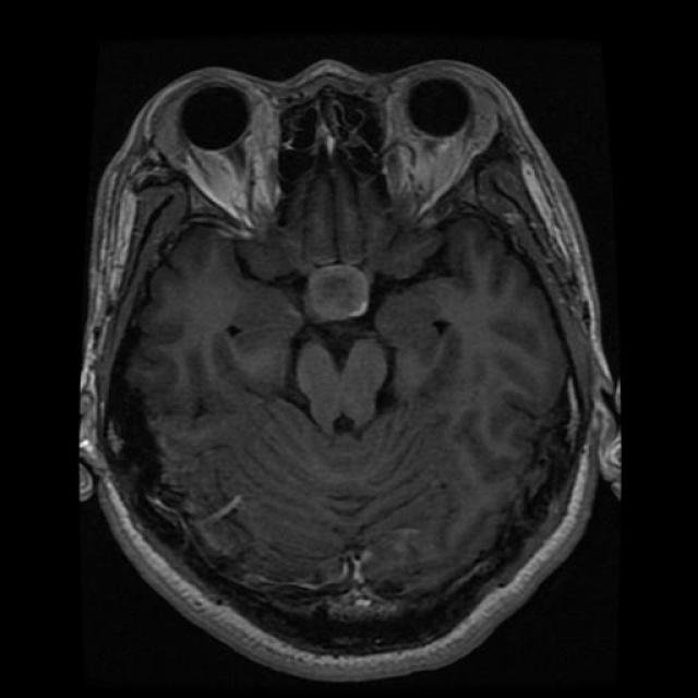 brain tumor classification Classification Model by UCLA