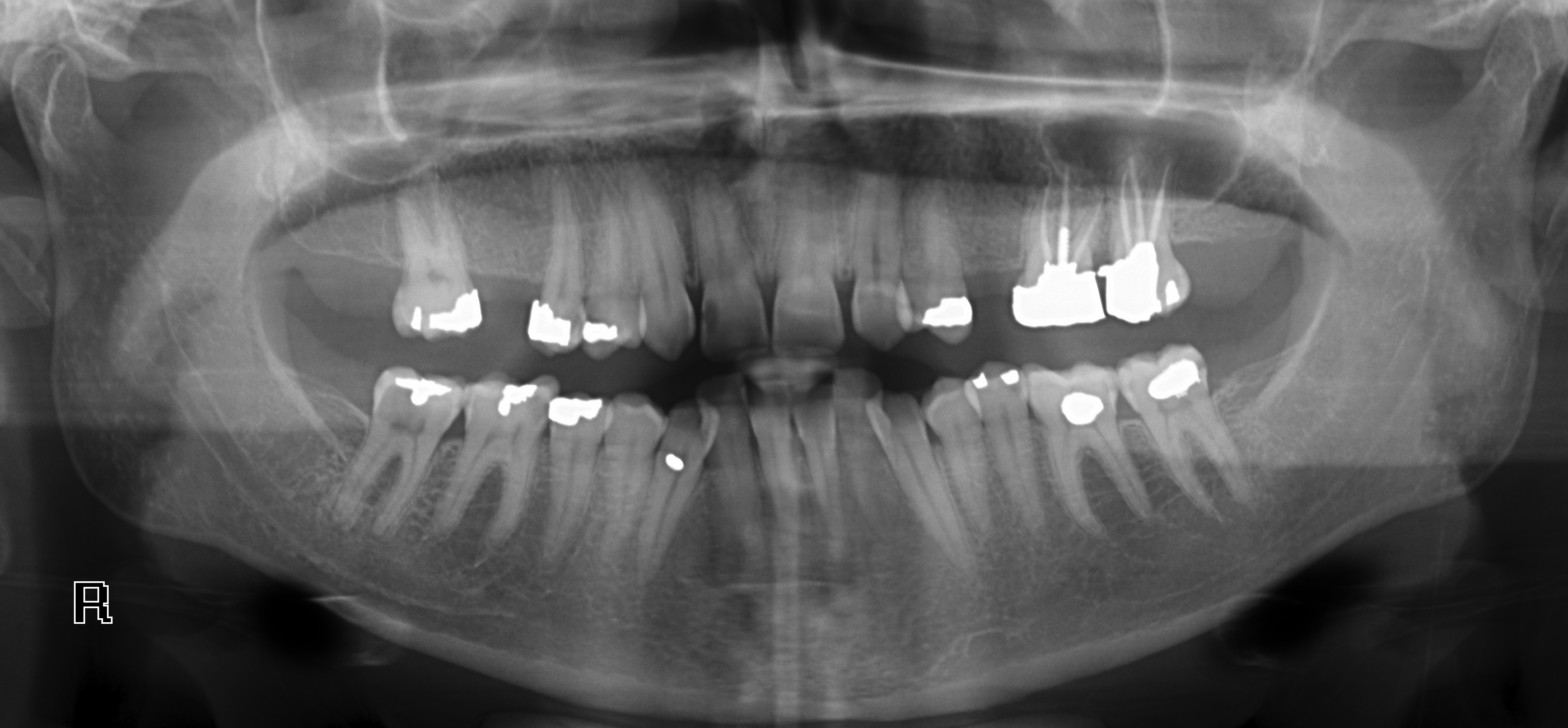 Bone Loss in Xrays Instance Segmentation Model by ISEF