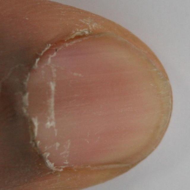 nail_disease_own_dataset Object Detection Dataset by Nail