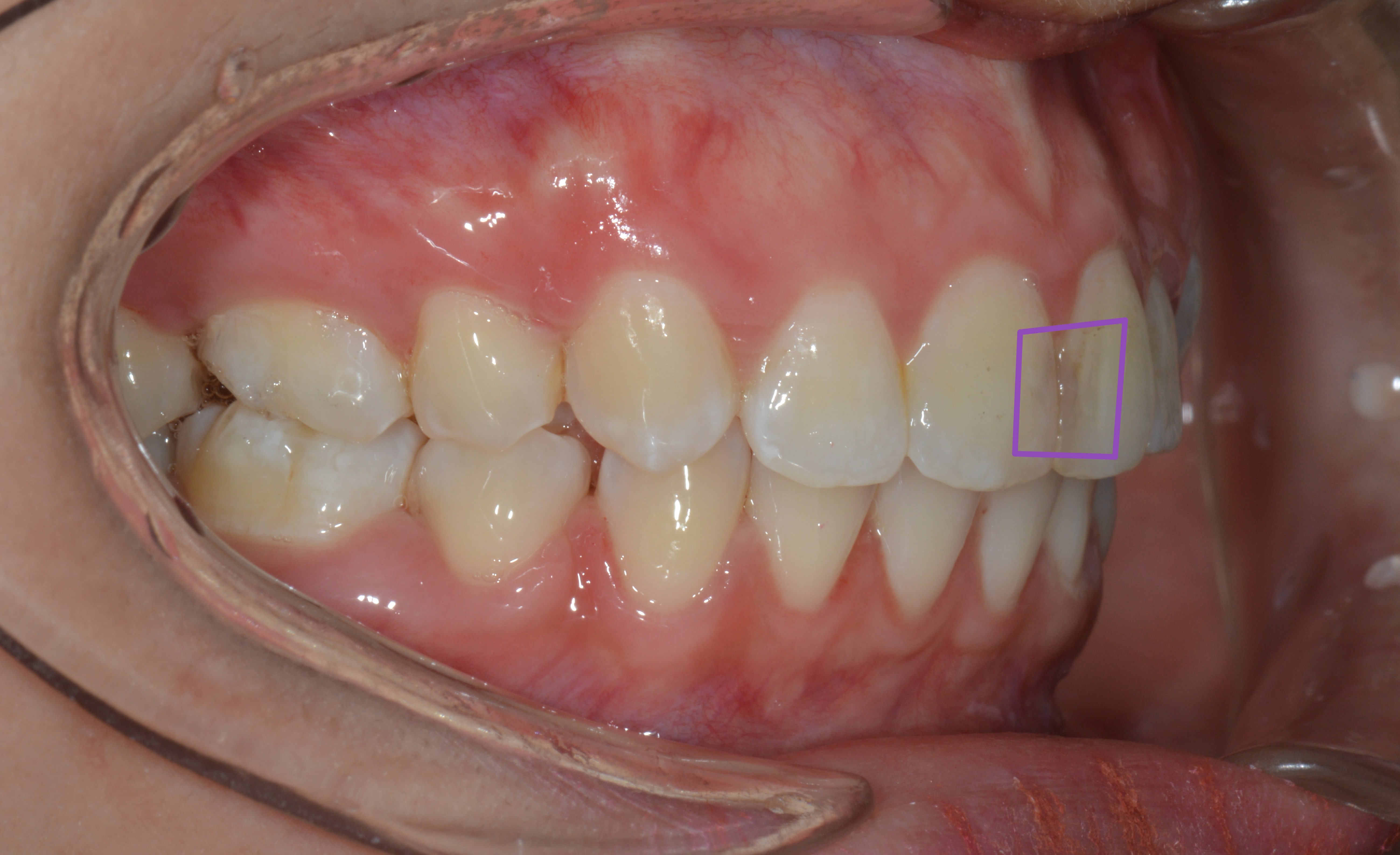 dental lesion Object Detection Dataset and Pre-Trained Model by dent