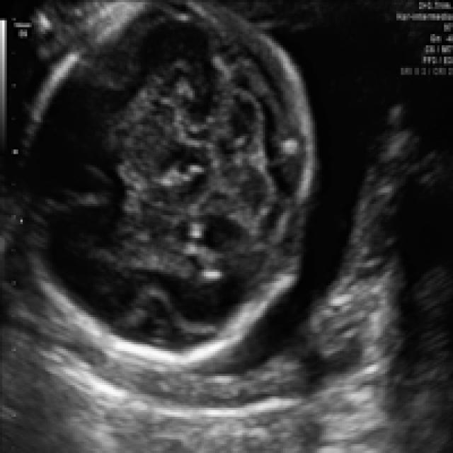 Fetal Brain Detection Object Detection Dataset By Ves Institute Of