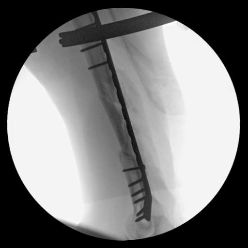 Bone Fracture Detection Object Detection Dataset By Bone Fracture
