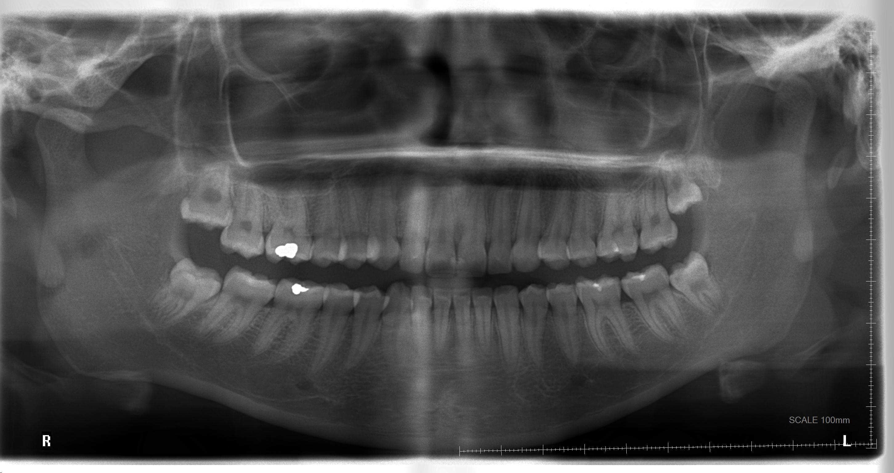 teeth_segmentation Semantic Segmentation Model by yimdobin