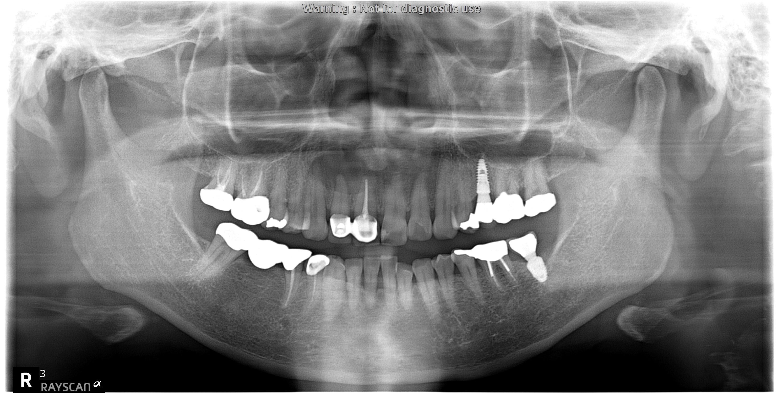 teeth_segmentation2_ Instance Segmentation Dataset and Pre-Trained Model by yimdobin